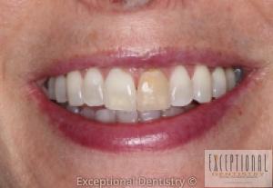 Cosmetic Bonding - Exceptional Dentistry - Dr. Ted Murray