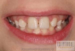 Cosmetic Bonding - Exceptional Dentistry - Dr. Ted Murray