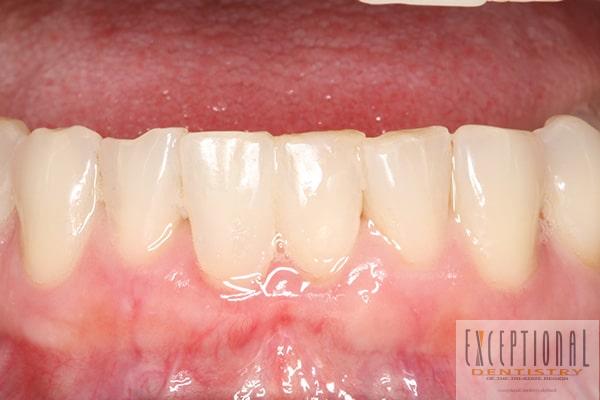 Cosmetic Bonding Archives - Exceptional Dentistry - Dr. Ted Murray