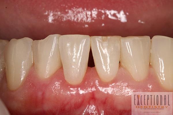 Cosmetic Bonding Archives - Exceptional Dentistry - Dr. Ted Murray