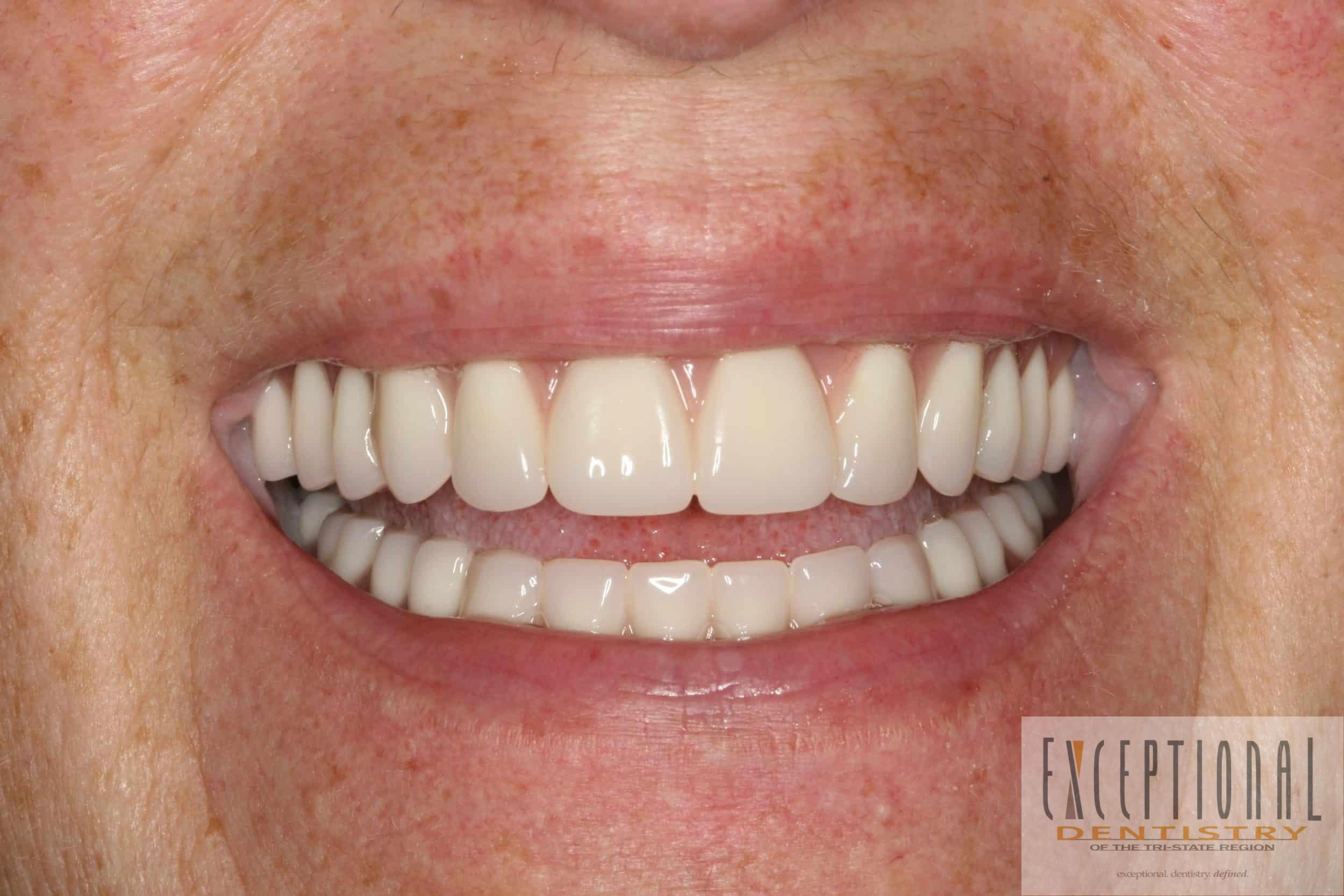 Dentures Archives - Exceptional Dentistry - Dr. Ted Murray