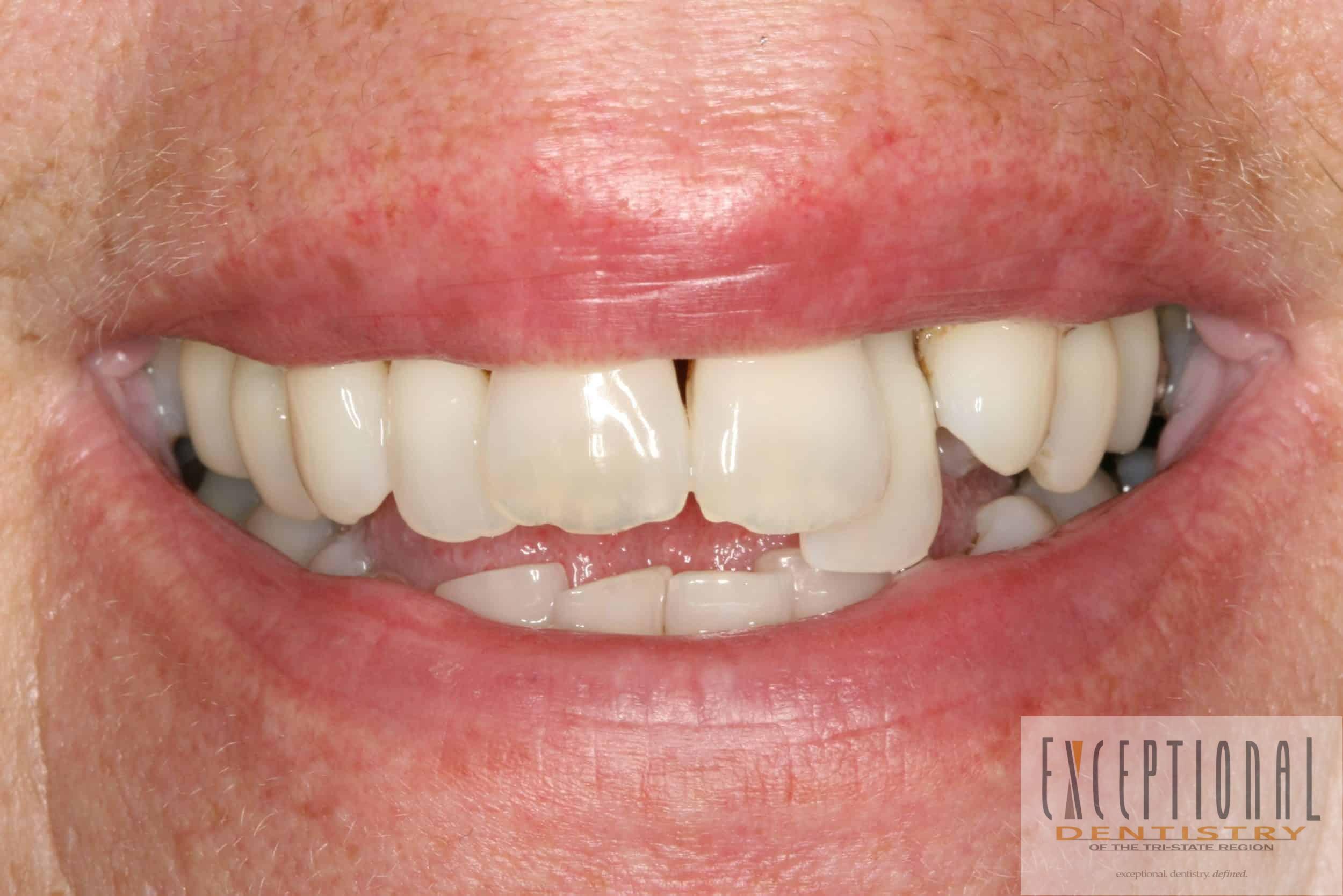 Dentures Archives - Exceptional Dentistry - Dr. Ted Murray