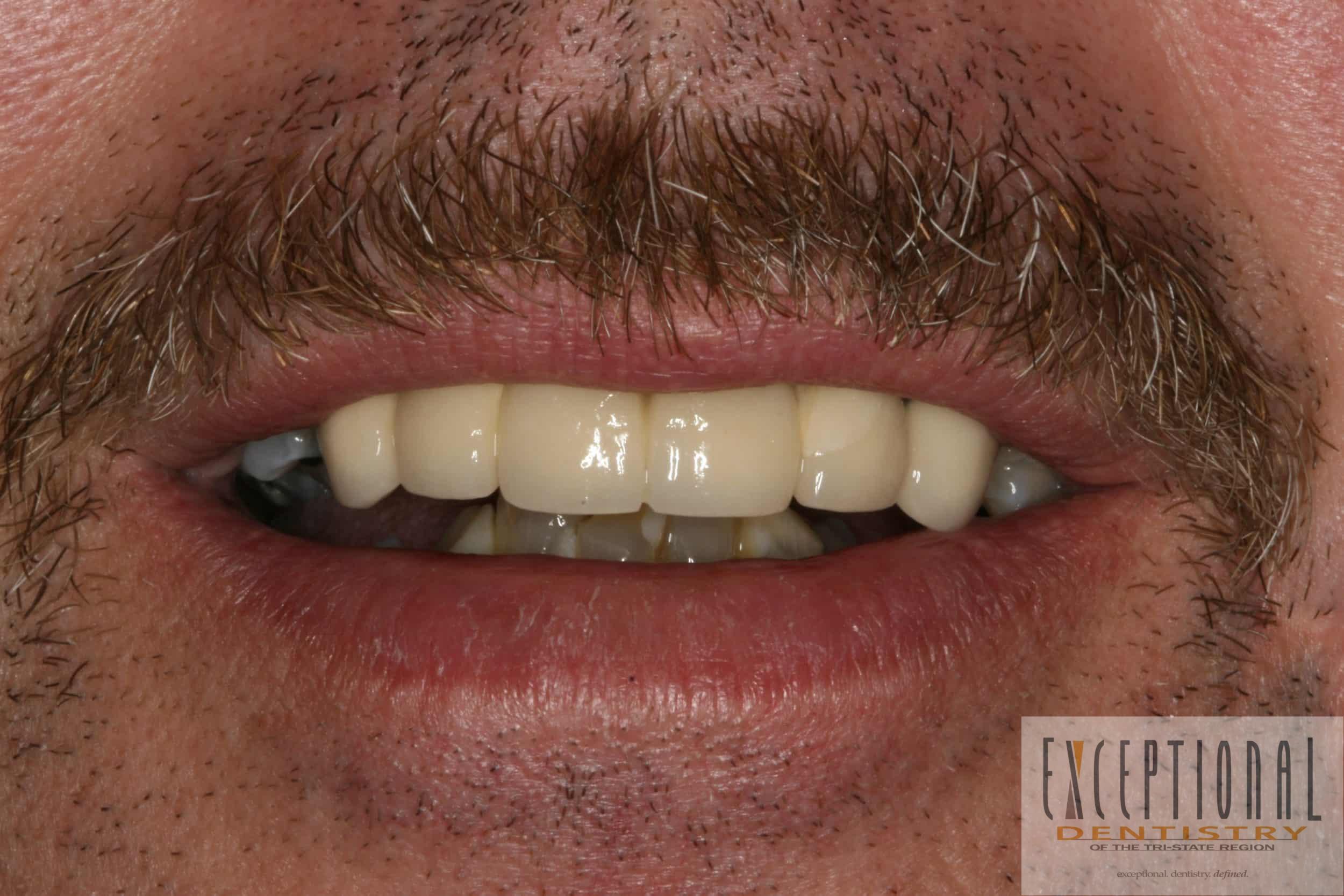 Dentures Archives - Dr. Kristen Berning & Dr. Alexia Oetken