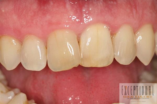 Whitening Archives - Dr. Kristen Berning & Dr. Alexia Oetken