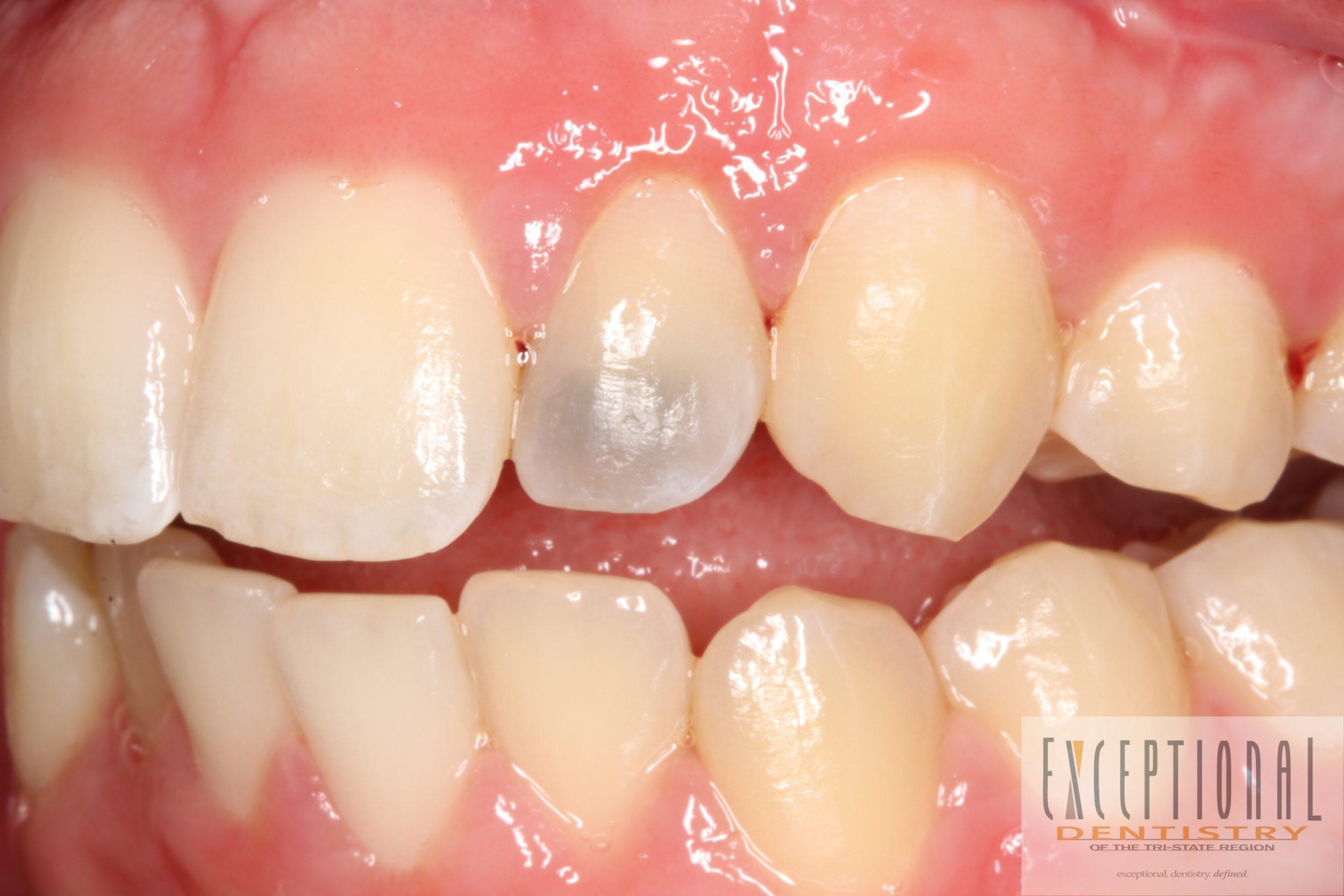 Whitening - Dr. Kristen Berning & Dr. Alexia Oetken