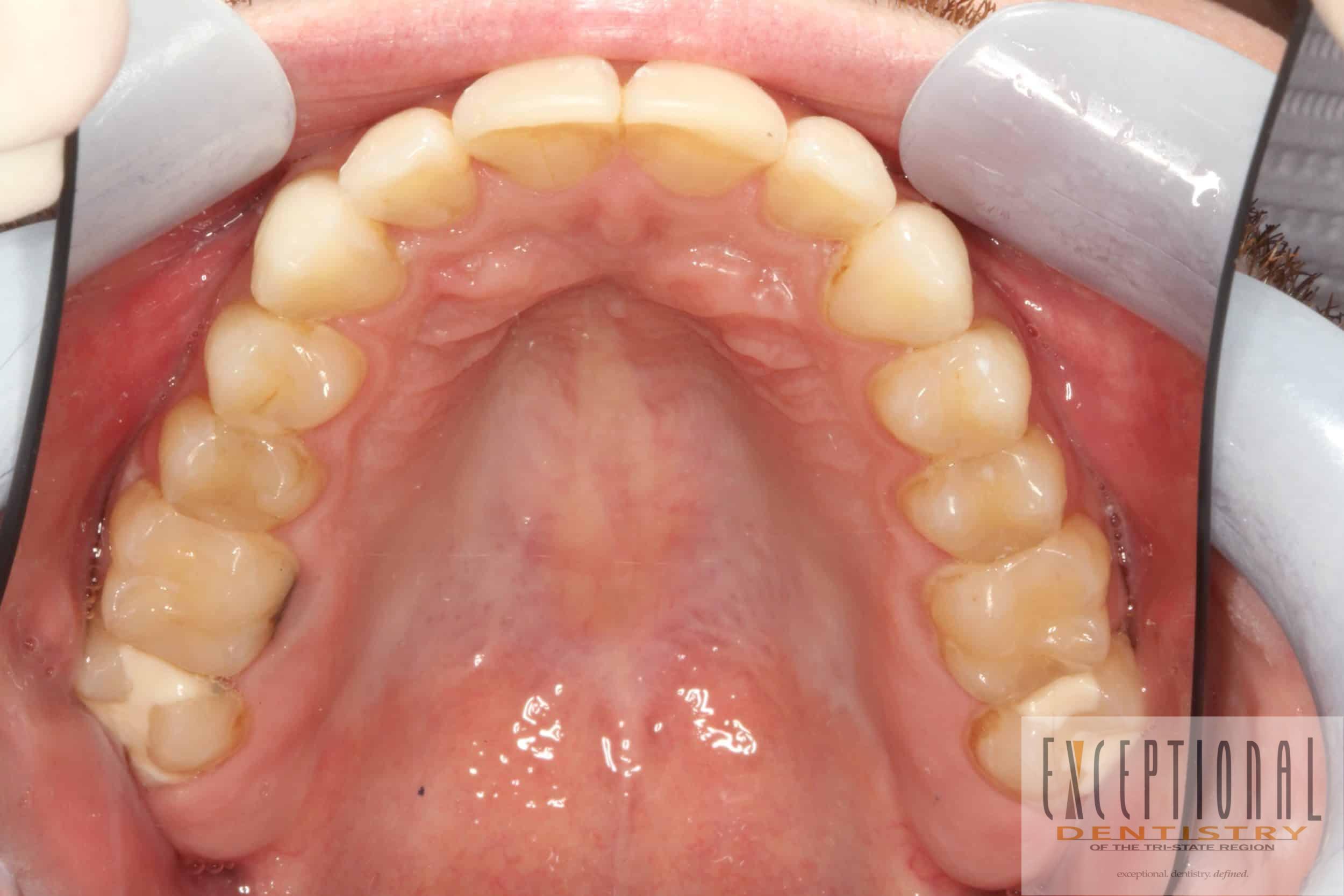 Invisalign - Dr. Kristen Berning & Dr. Alexia Oetken