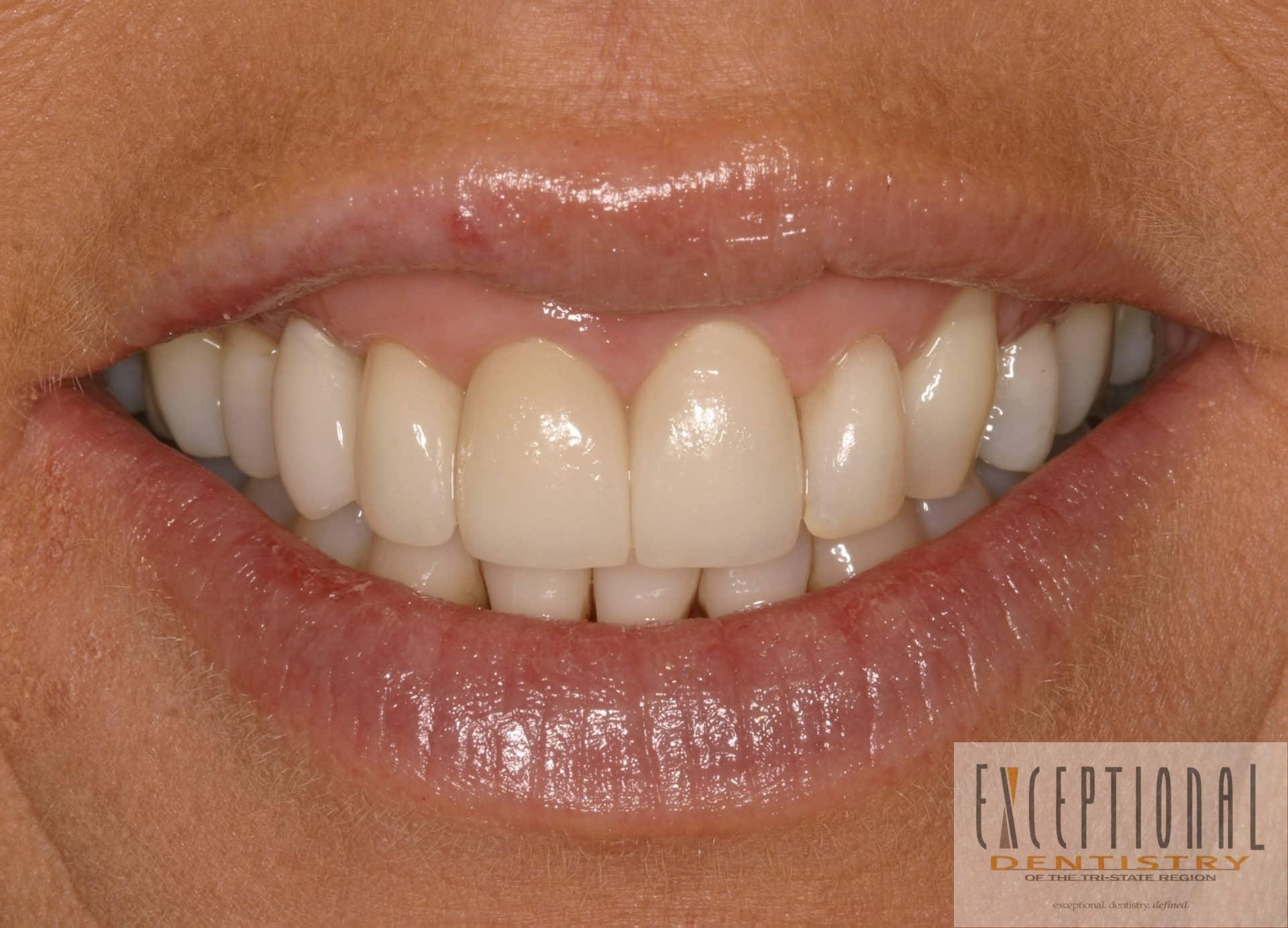 Porcelain Veneers Archives - Dr. Kristen Berning & Dr. Alexia Oetken