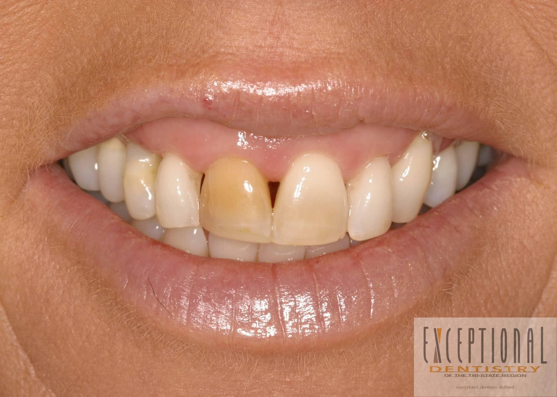 Porcelain Veneers Archives - Dr. Kristen Berning & Dr. Alexia Oetken