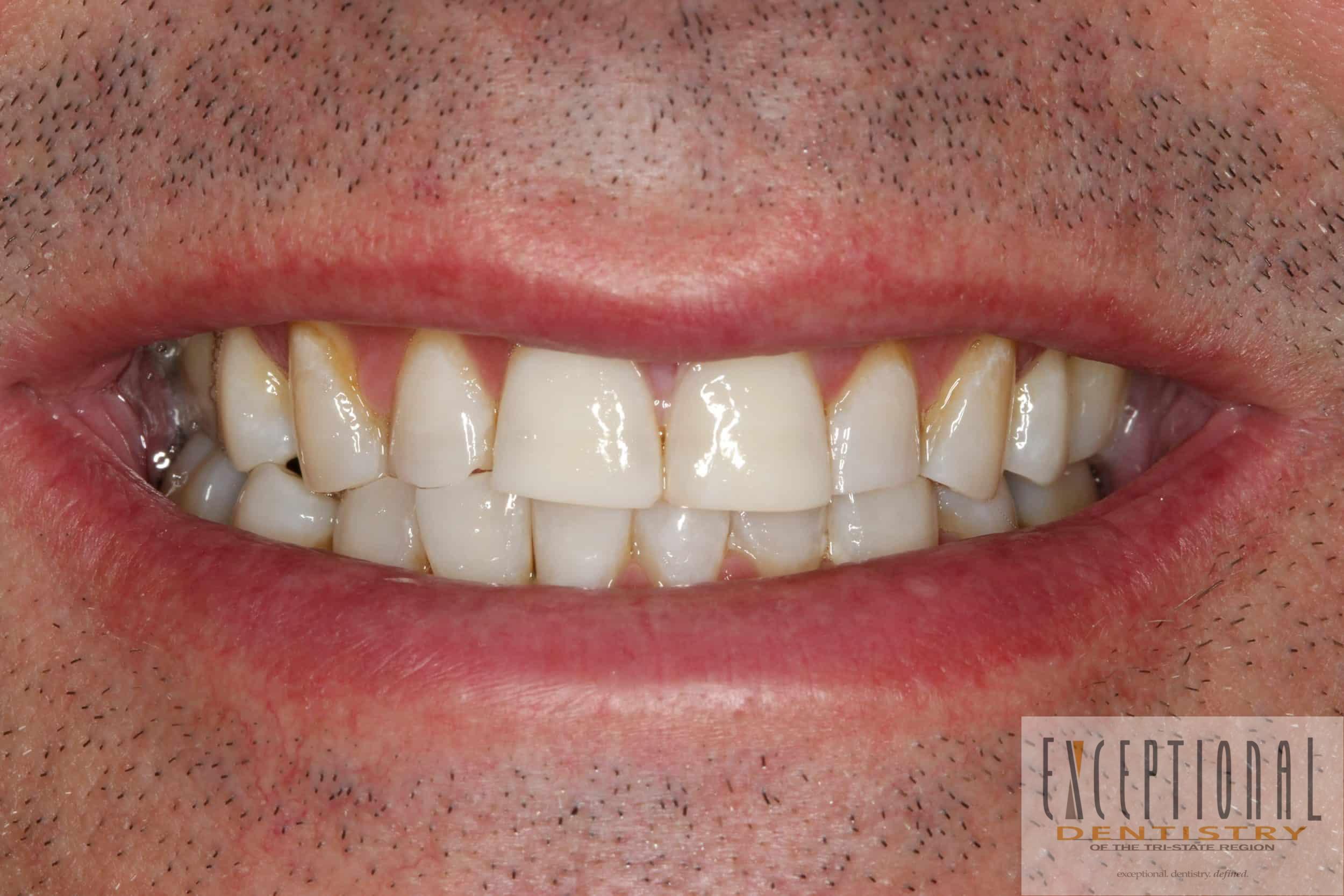 Whitening Archives - Dr. Kristen Berning & Dr. Alexia Oetken
