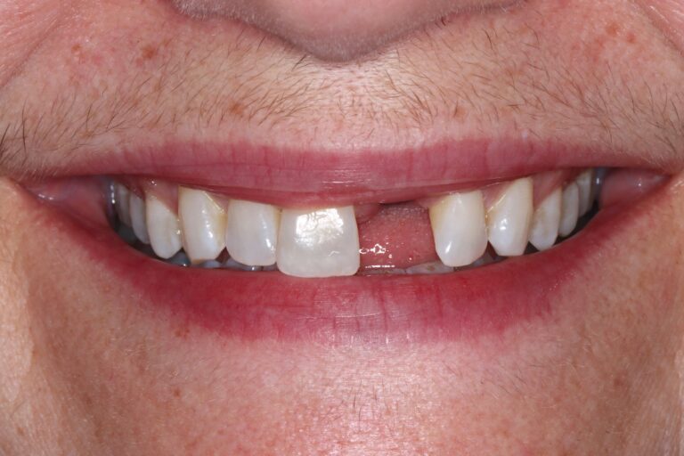 Implant front tooth - Exceptional Dentistry - Dr. Ted Murray