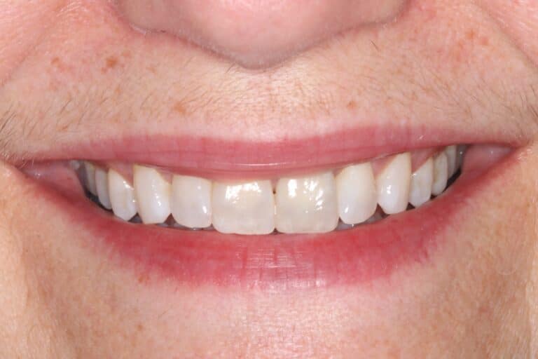 Implant front tooth - Dr. Kristen Berning & Dr. Alexia Oetken