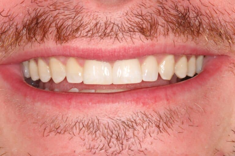 Cosmetic Bonding to close space - Dr. Kristen Berning & Dr. Alexia Oetken