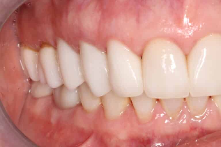 Dental Implant Molar - Dr. Kristen Berning & Dr. Alexia Oetken