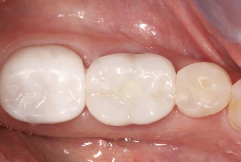 Dental Implant Molar - Dr. Kristen Berning & Dr. Alexia Oetken