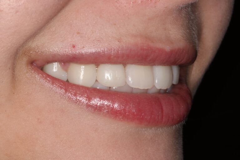 Cosmetic Bonding anterior - Dr. Kristen Berning & Dr. Alexia Oetken